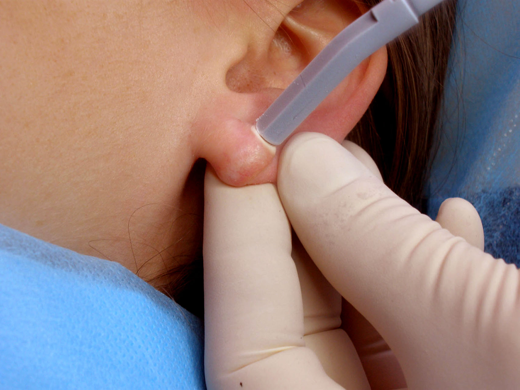 Kryoterapi / kryokirurgi - Vasaderm